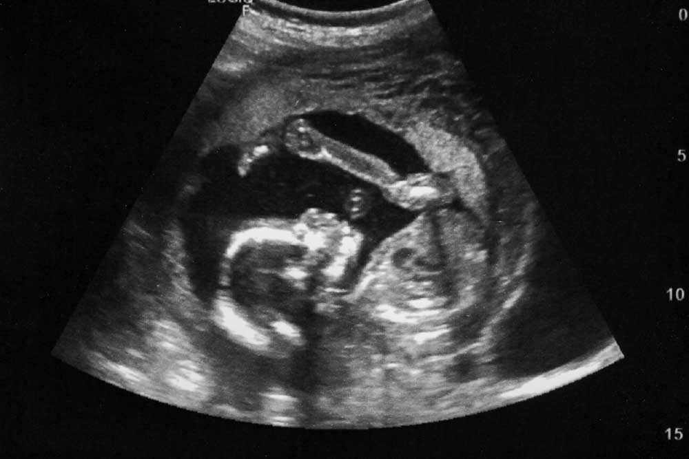 What To Expect From An Early Ultrasound Scan - Answers For Life Tucson